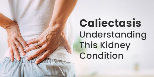 Caliectasis: Understanding This Kidney Condition
