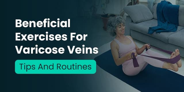 Beneficial Exercises for Varicose Veins: Tips and Routines