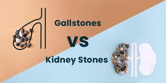 Gallstones vs Kidney Stones: Differences and Similarities