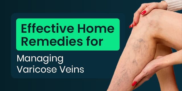 Effective Home Remedies for Managing Varicose Veins